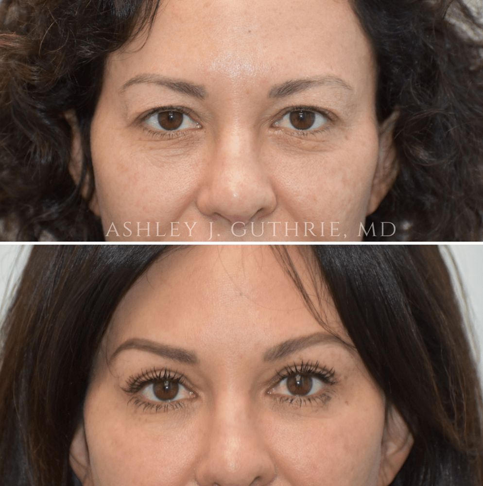 Upper Blepharoplasty - Real Patient Before & After