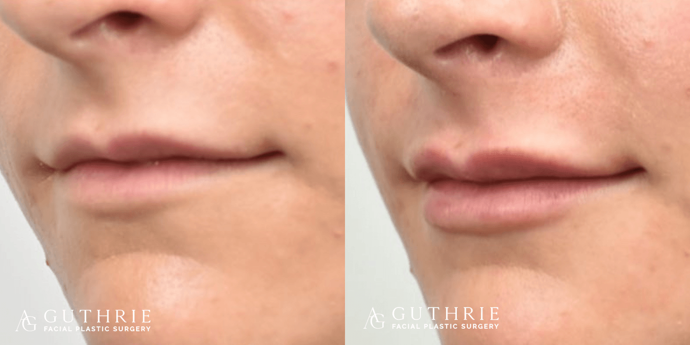 Lip Fillers - Before & After Gallery