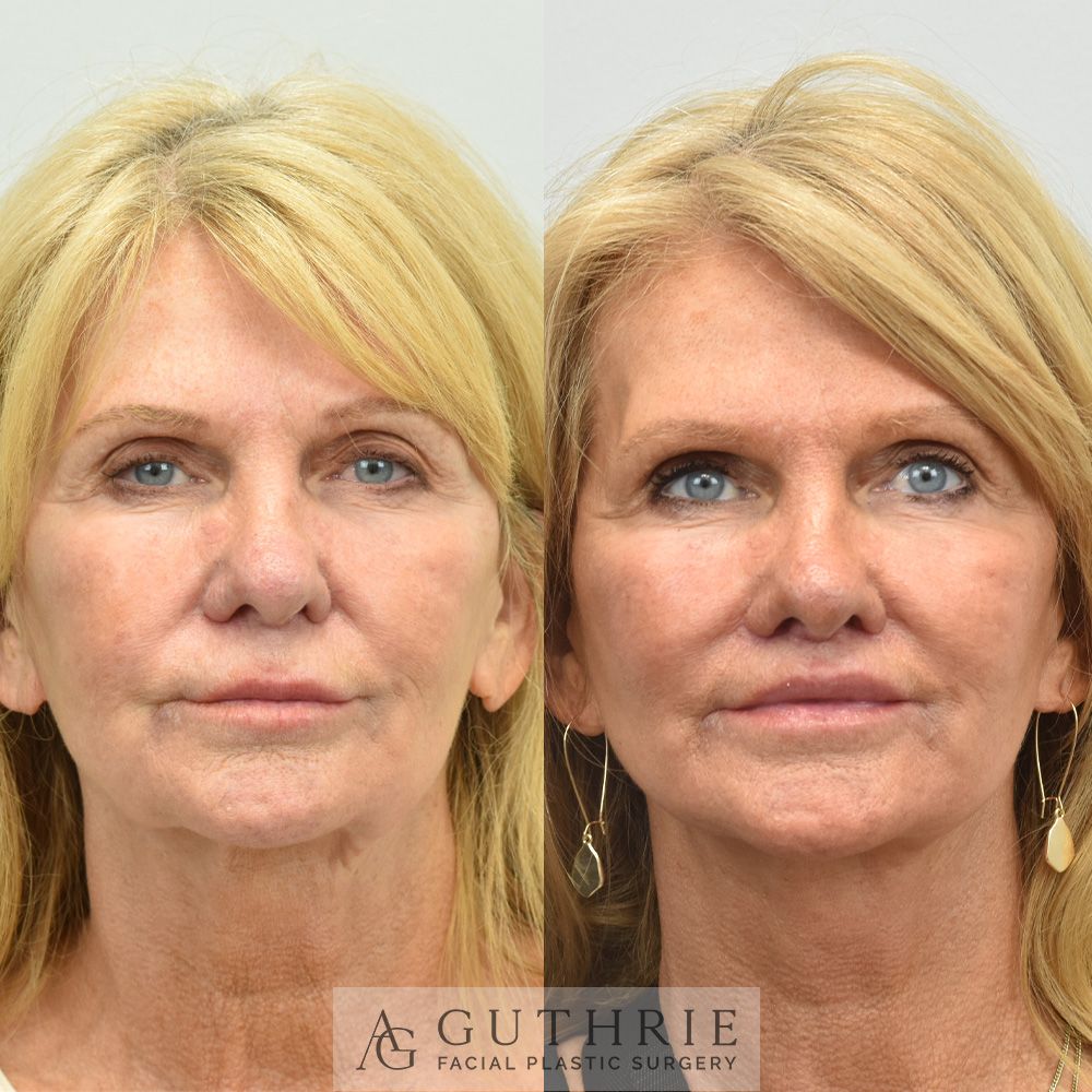 Lip Lift - Before & After Gallery