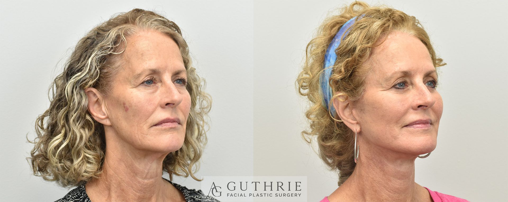 Facelift / Necklift - Before & After Gallery