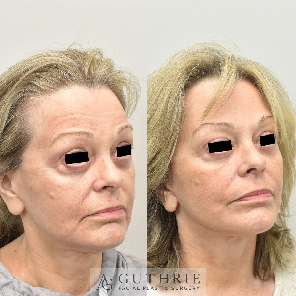 Facelift - Before & After Gallery | Dr. Ashely Guthrie
