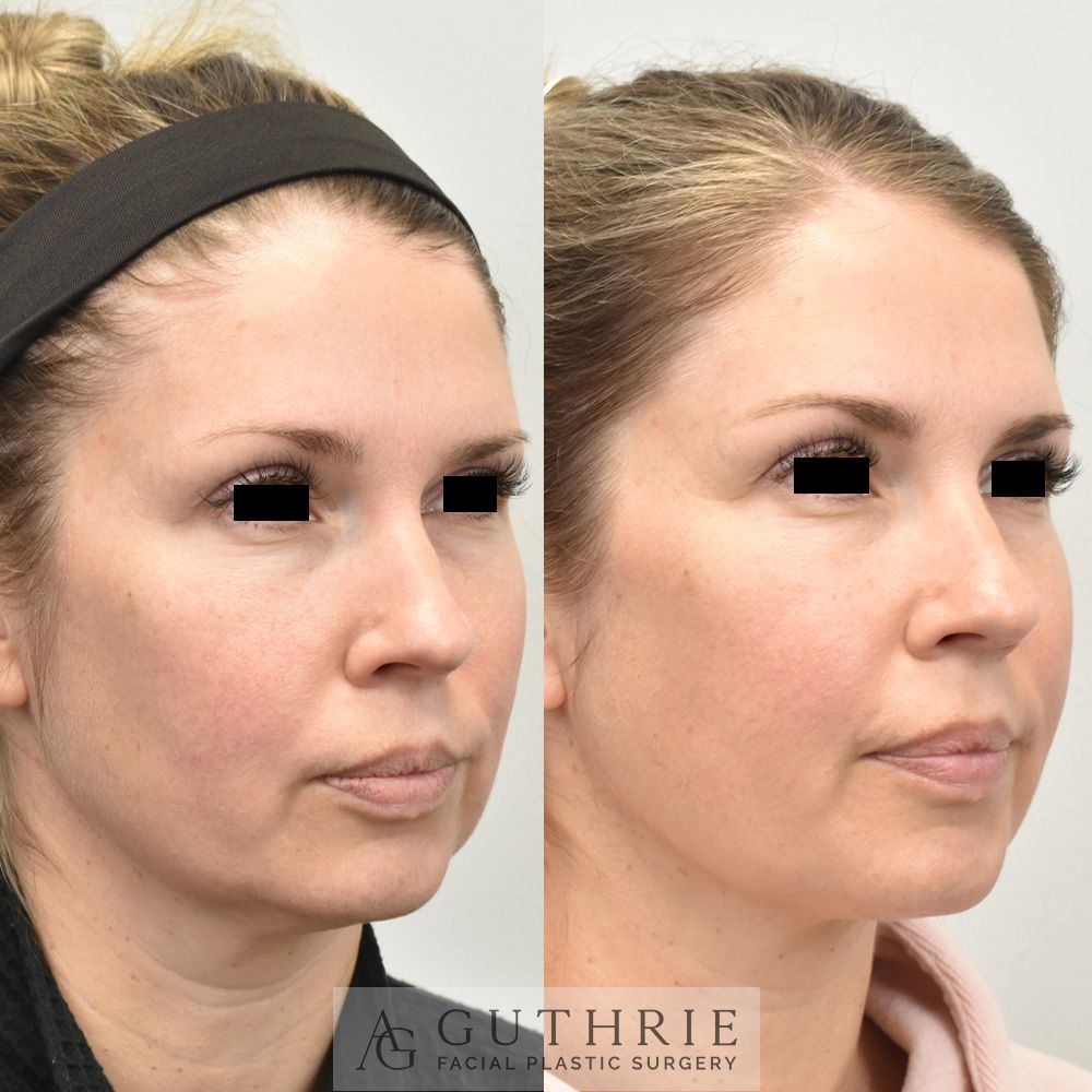 FaceTite™ - Before & After Gallery | Dr. Ashely Guthrie