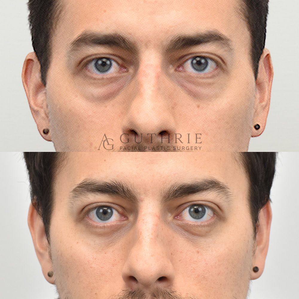 Lower Blepharoplasty - Real Patient Before & After