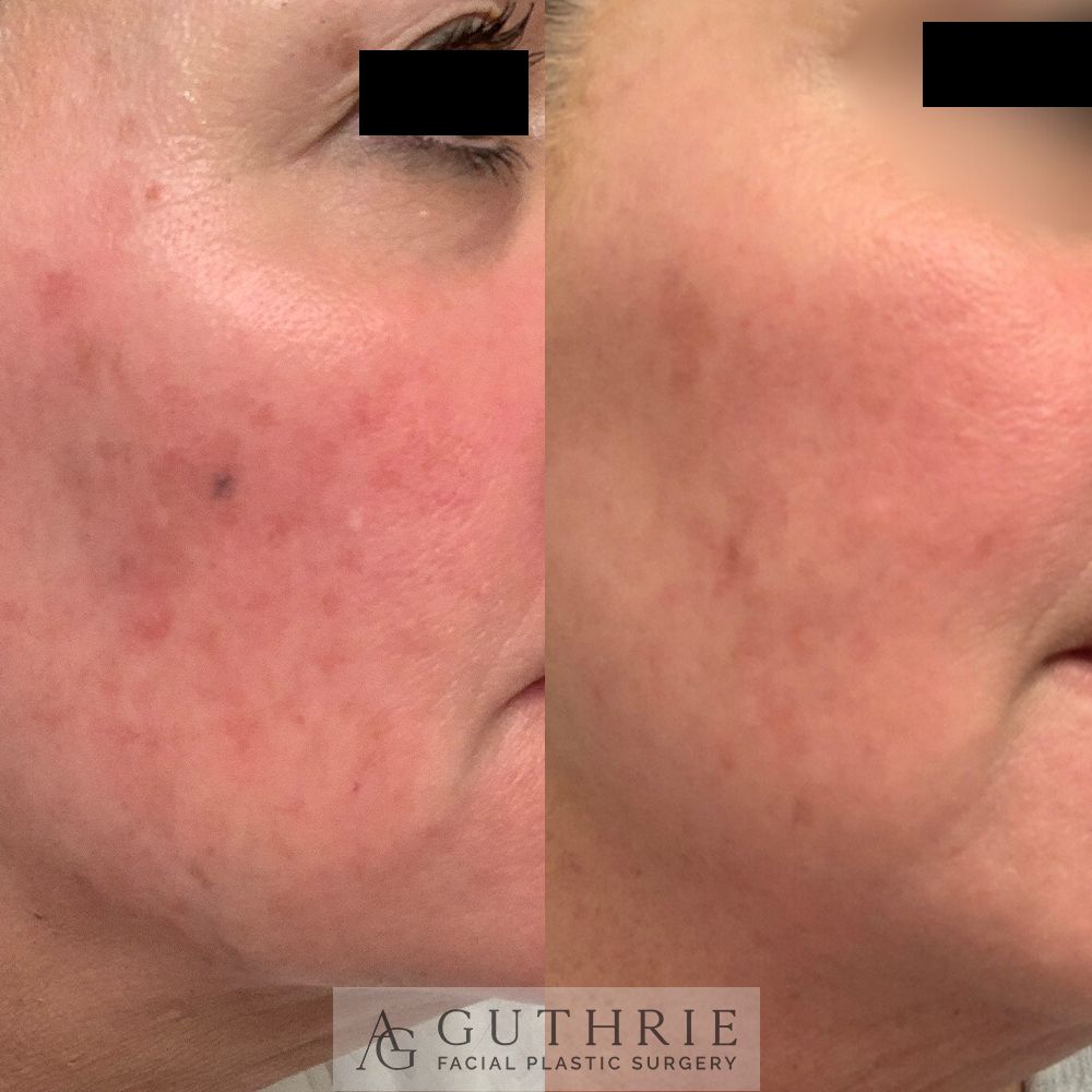 CO2 Laser Skin Resurfacing - Before & After Gallery