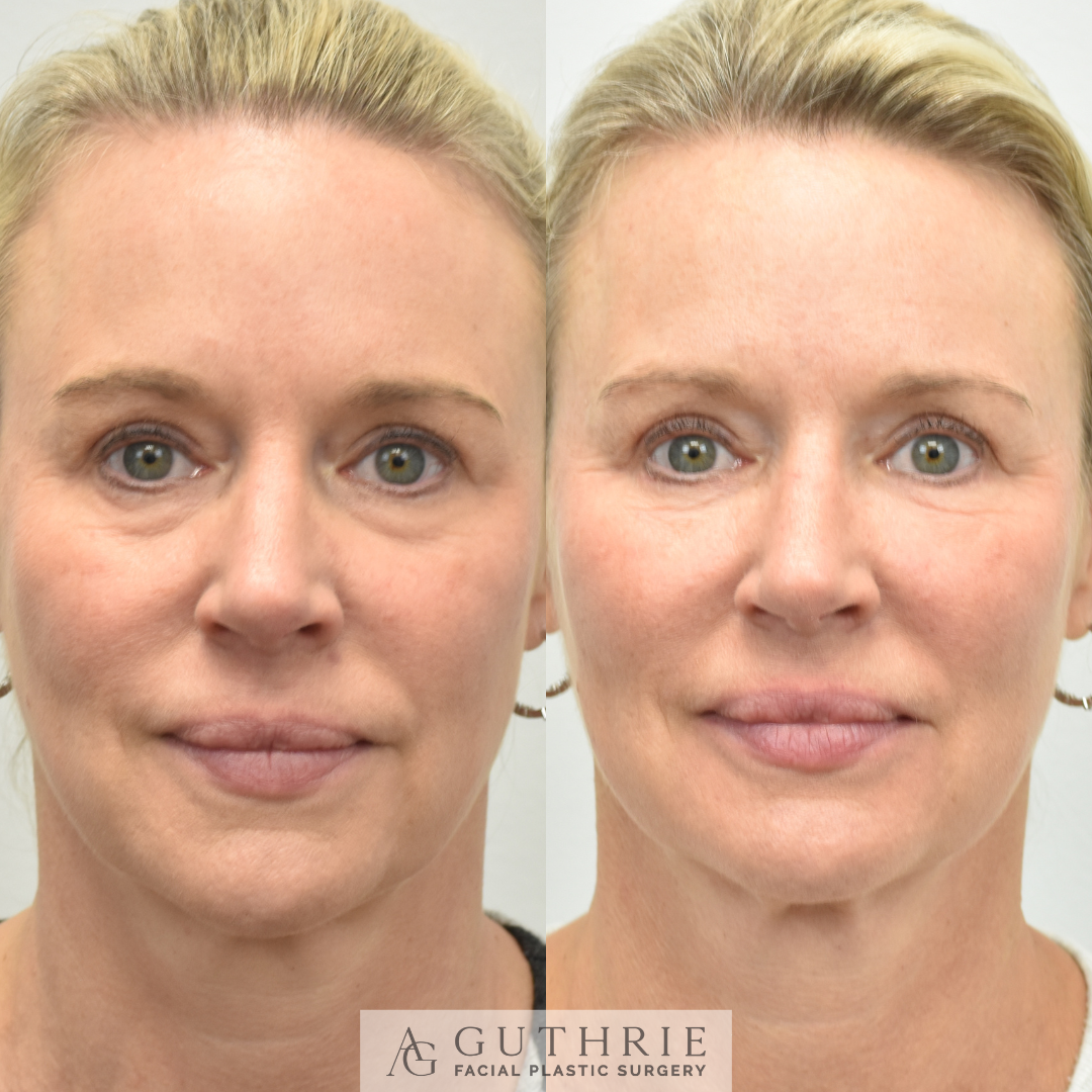 Lower Blepharoplasty - Real Patient Before & After