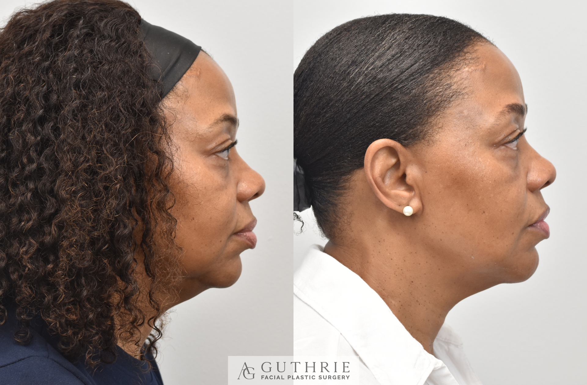 Facial Implants - Before & After Gallery