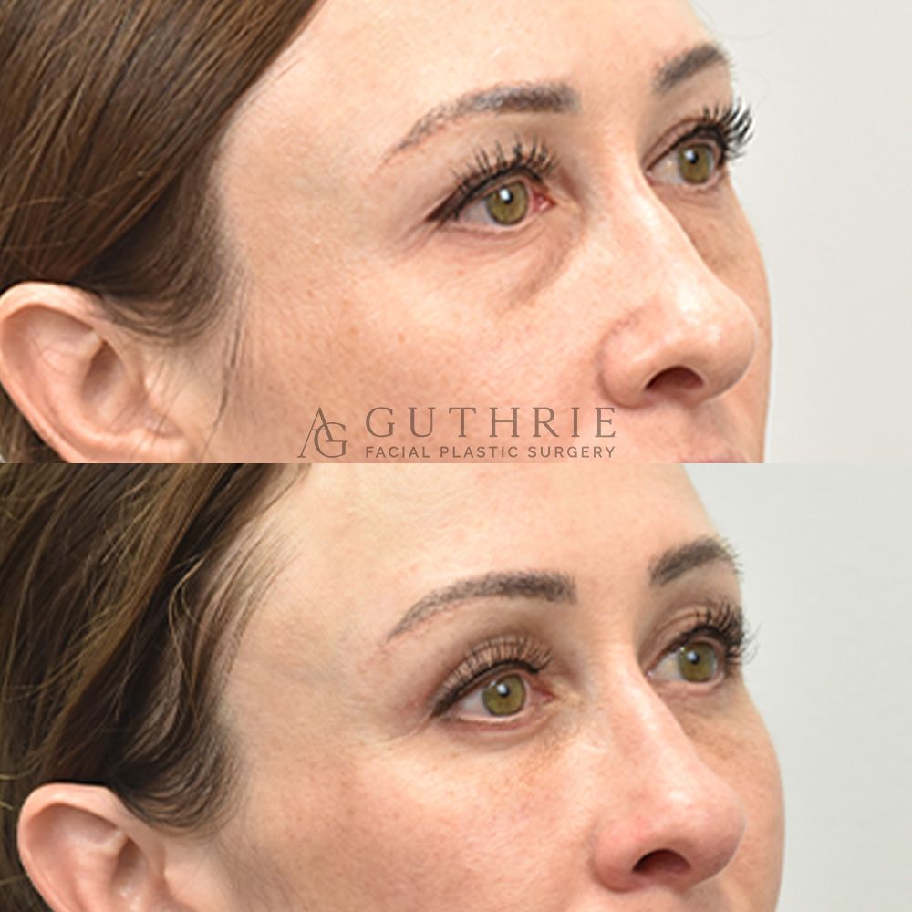 Blepharoplasty - Real Patient Before & After