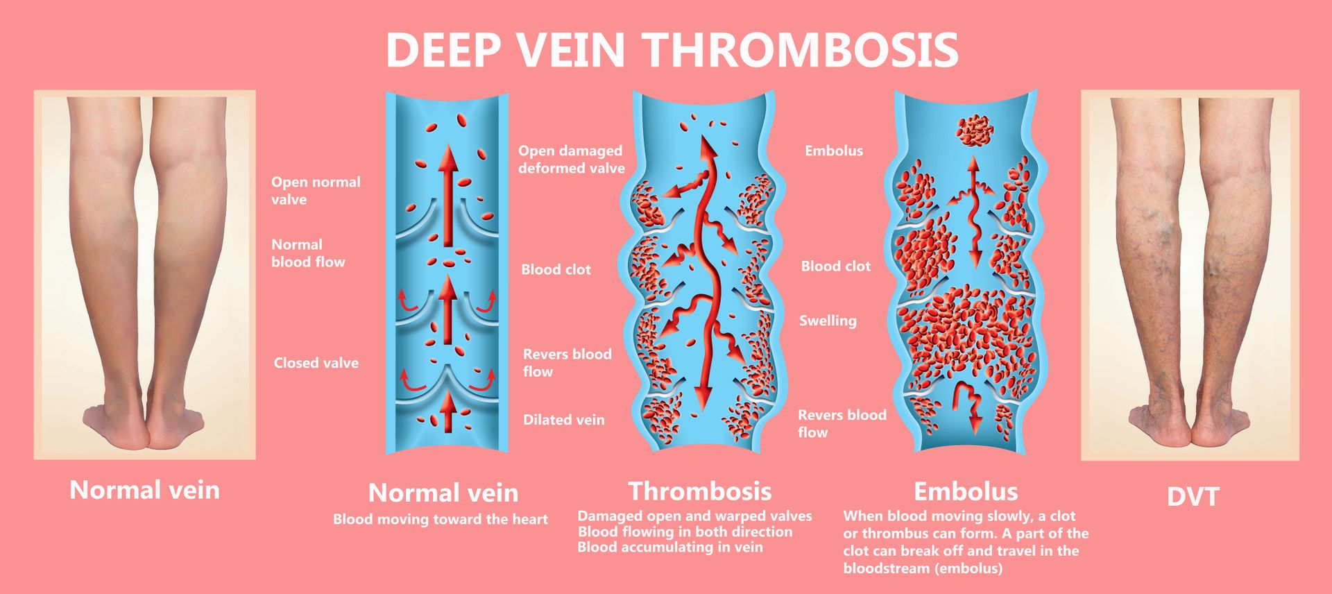 Venous Thrombosis: Causes, Symptoms, Prevention and Treatments