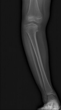 Deformity Correction | Sydney Orthopaedic and Sports Injury Service