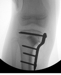 Deformity Correction | Sydney Orthopaedic and Sports Injury Service