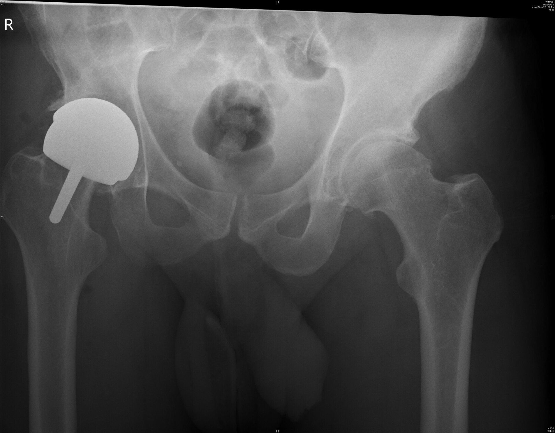 Hip Resurfacing | Sydney Orthopaedic and Sports Injury Service