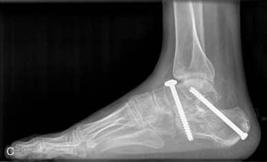 Foot & Ankle Fusions | Sydney Orthopaedic and Sports Injury Service
