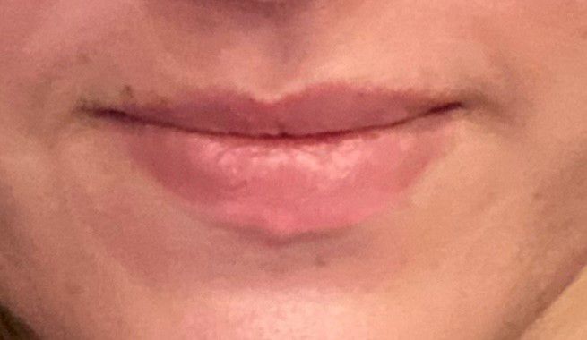 Vollure and Kyss Fillers | Marlton, NJ | A More Youthful You