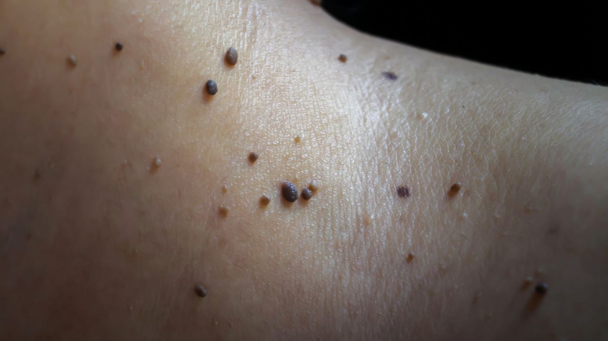 Skin Tag Removal in Albuquerque | My Skin Esthetics