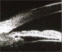 Angle-Closure Glaucoma | Advanced Eye Care NY