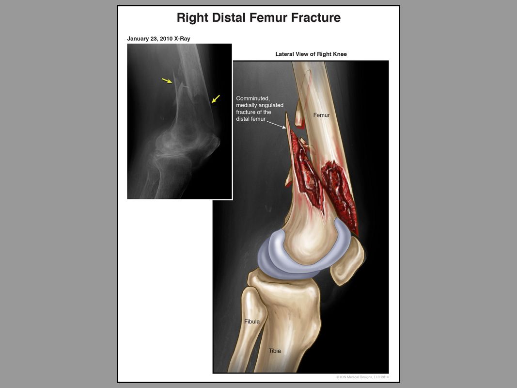 Showcase of Accurate and Visual Medical Illustrations | Ion Medical Designs