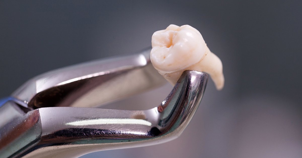 A Step-by-Step Guide on What to Do If You Lose a Tooth - SoHo Dental Group