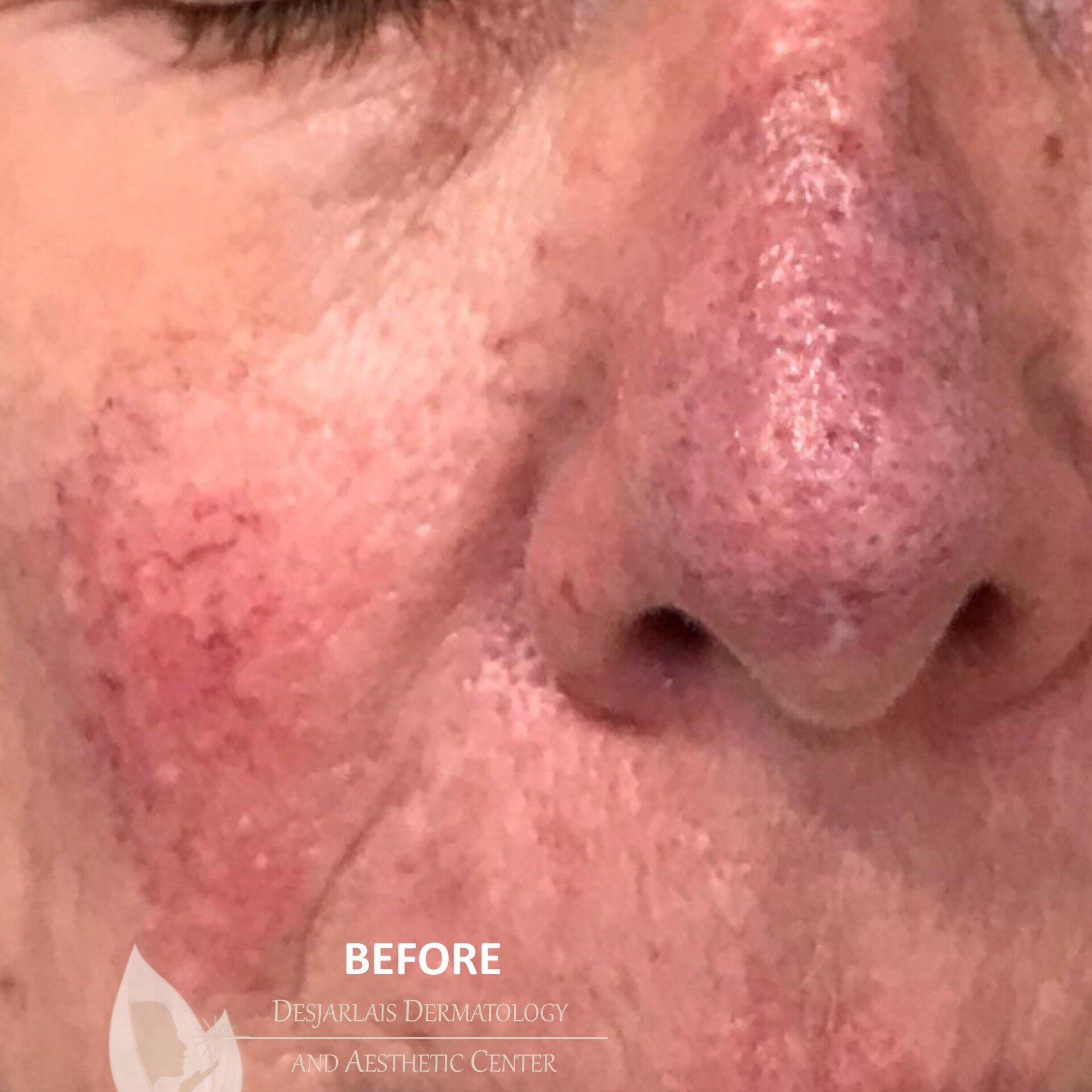 Before & After Gallery | Dr. Desjarlais Dermatology | Adrian, MI