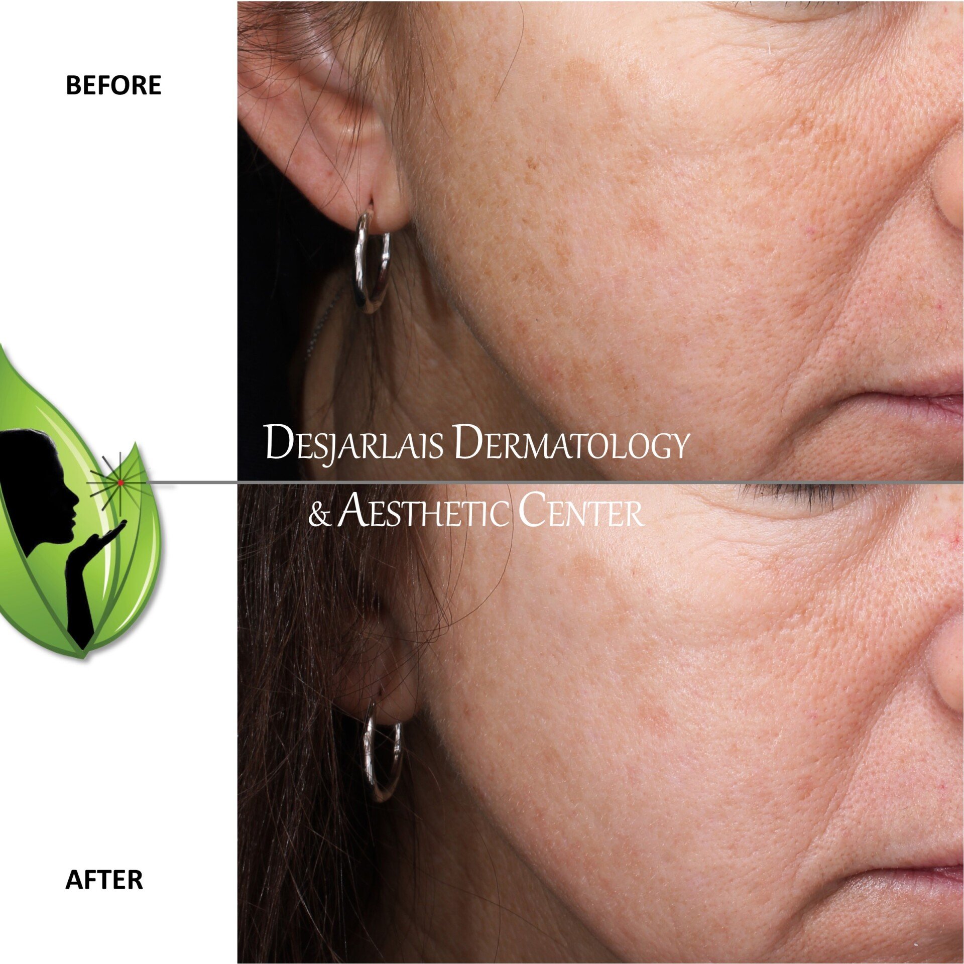 Skin Pigmentation & Tightening | Dr. Desjarlais Dermatology | Adrian, MI