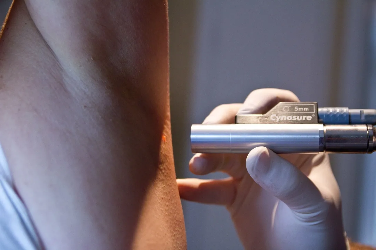 Laser Skin Tag Removal | Newmarket, ON | Anti-Aging Clinic Newmarket