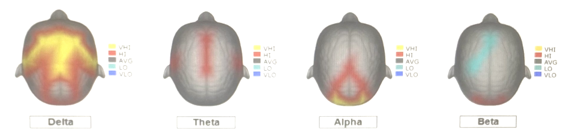 Neurofeedback, Brain Mapping, Life Coach, Military Support