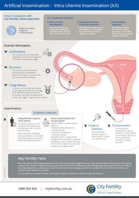 A Step-by-Step Guide to Intrauterine Insemination (IUI) - Precision IVF