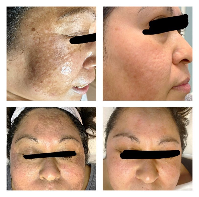 Depigmentation Treatment at Renu21