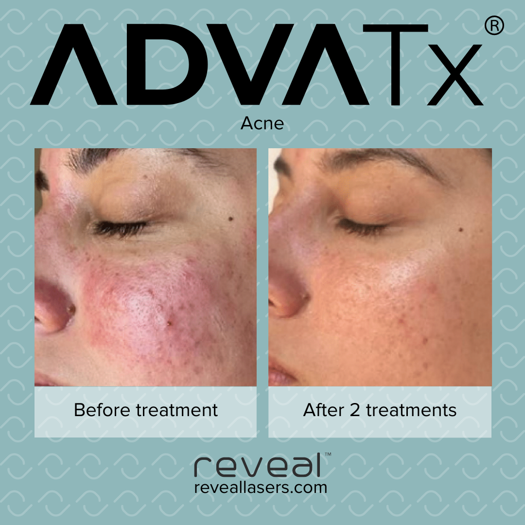 Laser Treatments | Pensacola, Florida | The Luxe Clinic