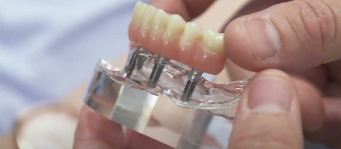 How Many Implants Are Needed For Full Mouth Tooth Replacement?