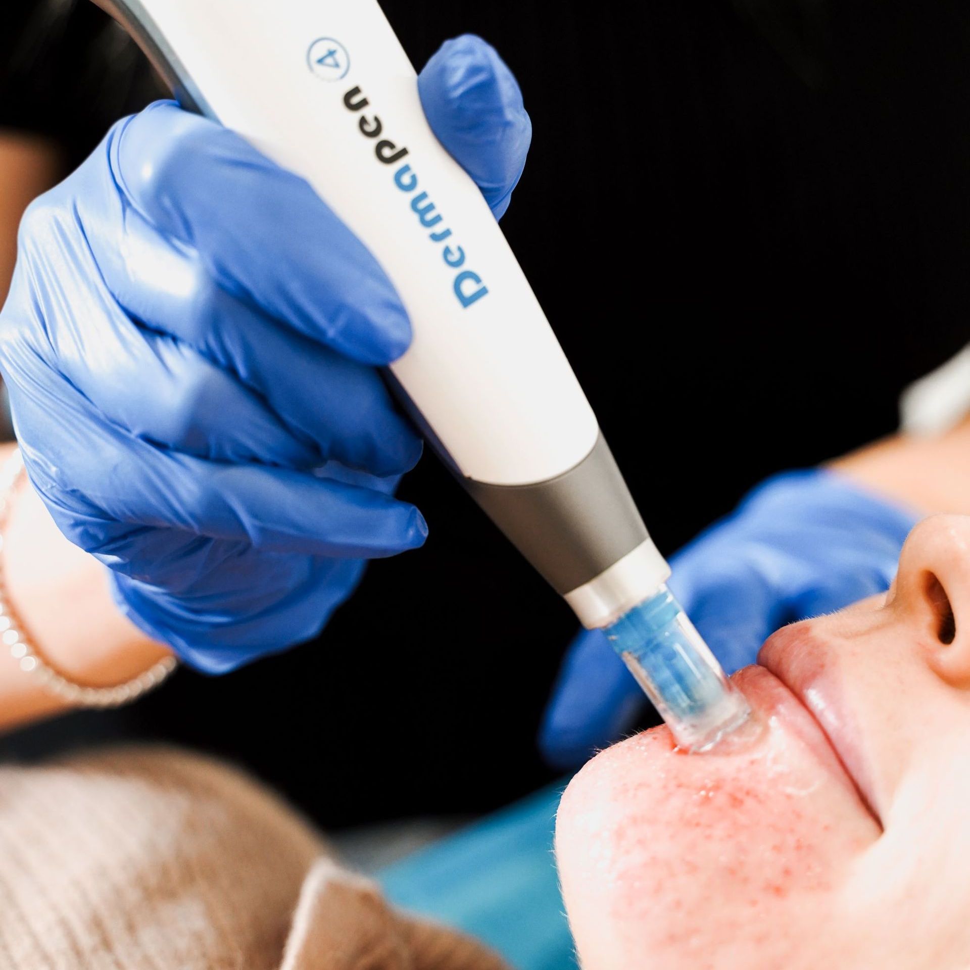 Microneedling with Exosomes