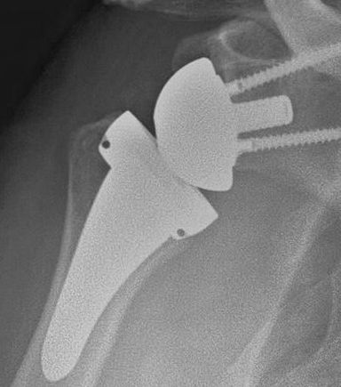 Total Shoulder Replacement | Ortho Surgeon Queensland | Dr Mwaturura