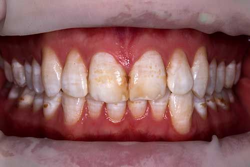 Fluorozė - vienas iš emalio struktūros pažeidimų