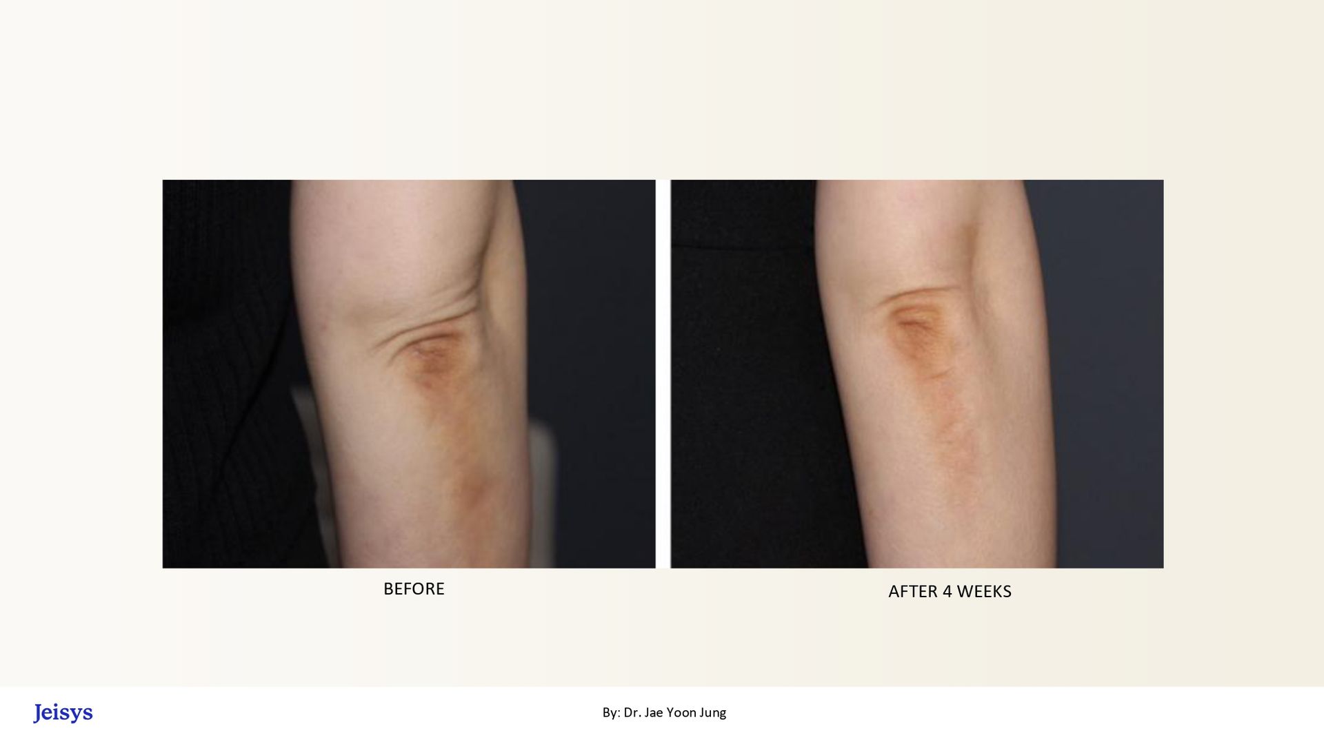 Laser Skin Tightening | Georgetown, TX | Truly Lifted MedSpa