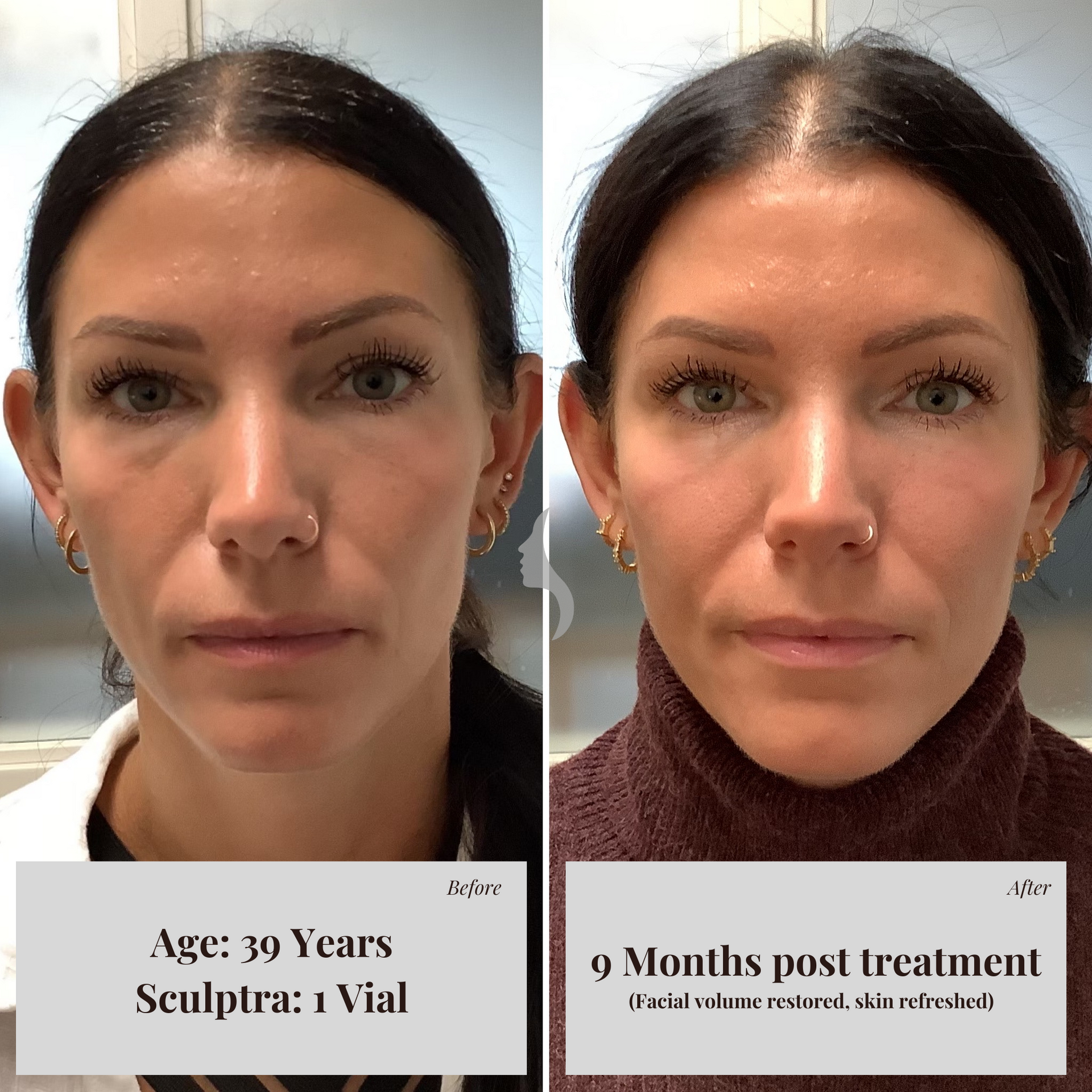 Naturally Restored Volume & Refreshed Skin