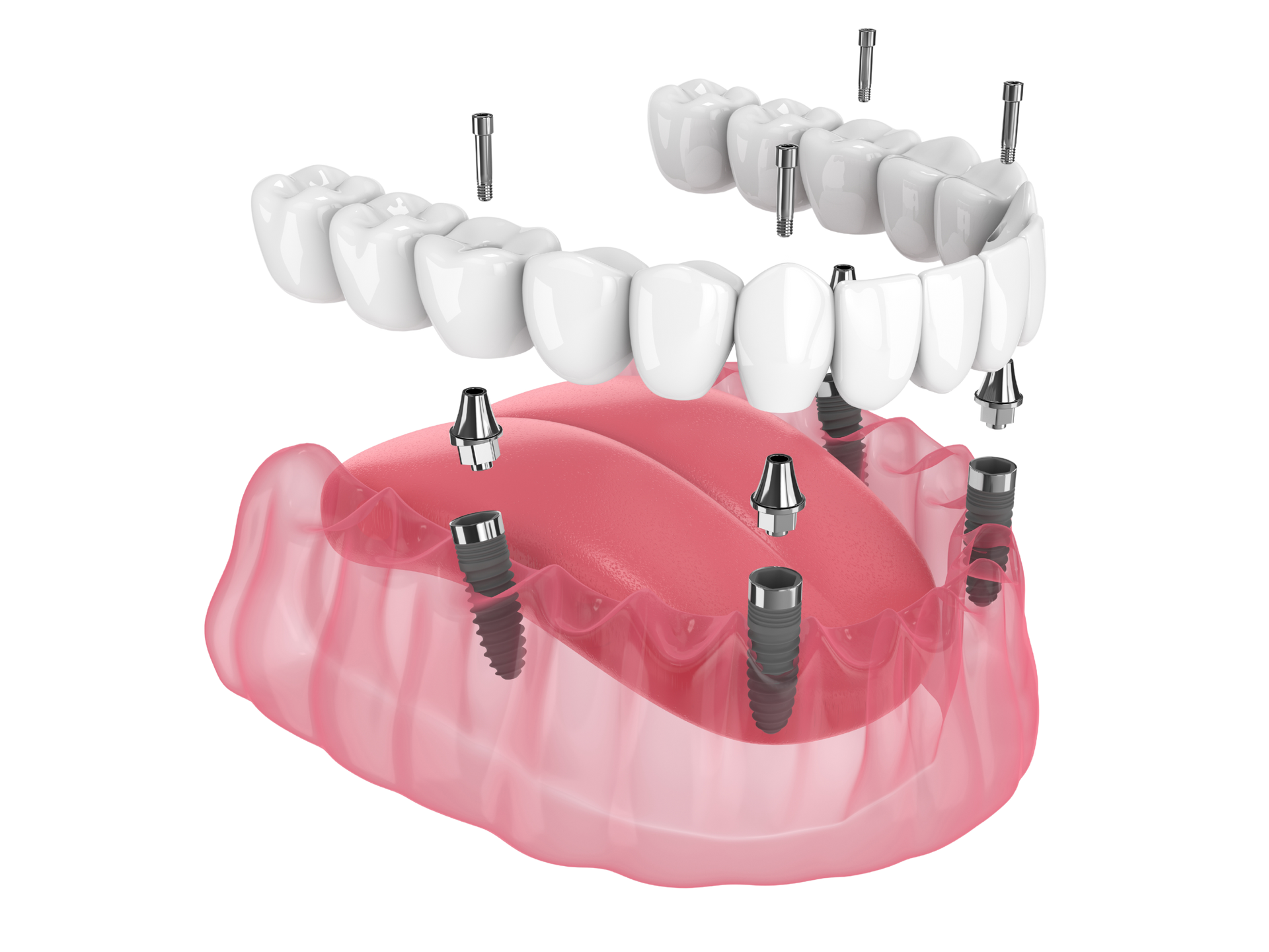 The Ultimate Guide to Are Dental Implants Right for You?