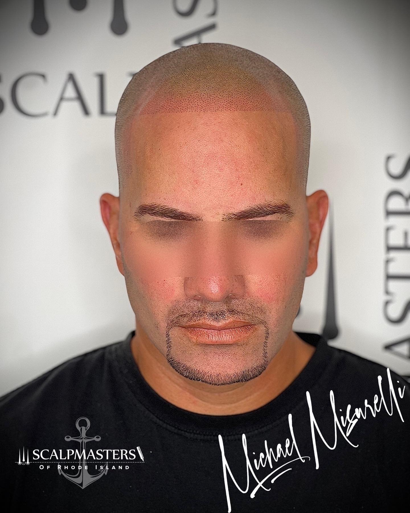 What You Must Know About Scalp Micropigmentation For Men
