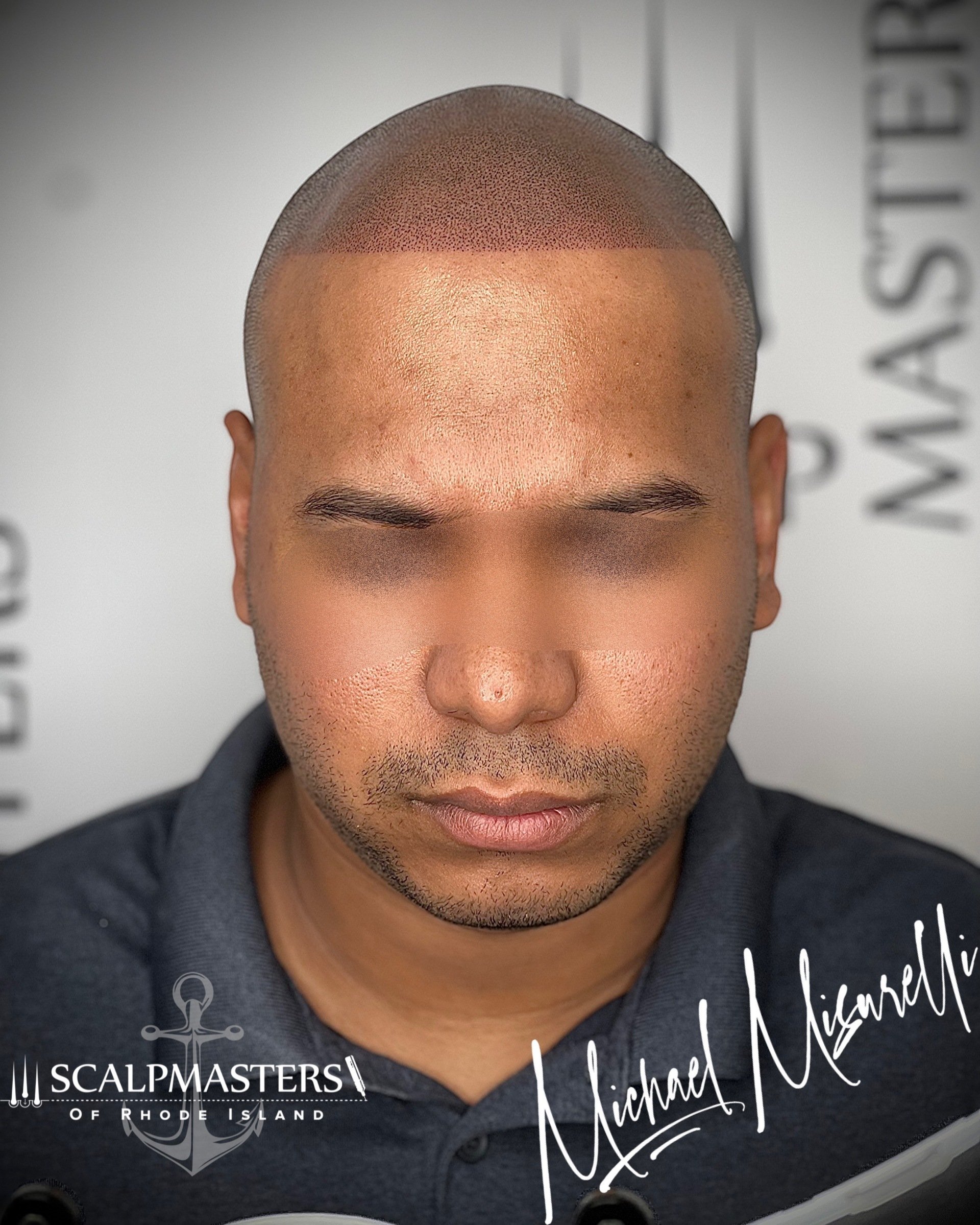 Scalp Micropigmentation For Men | Scalpmasters RI