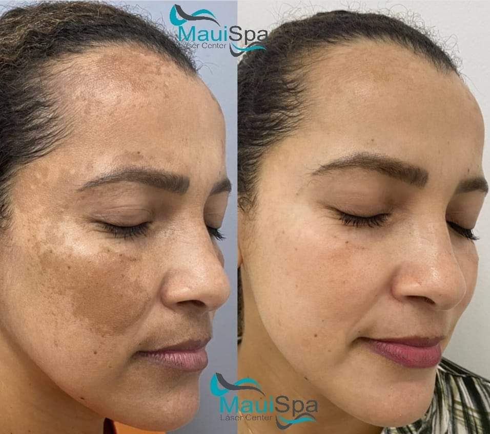 Cuidado de la piel - Maui Spa Láser Center