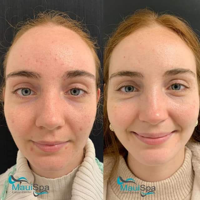 Cuidado de la piel - Maui Spa Láser Center