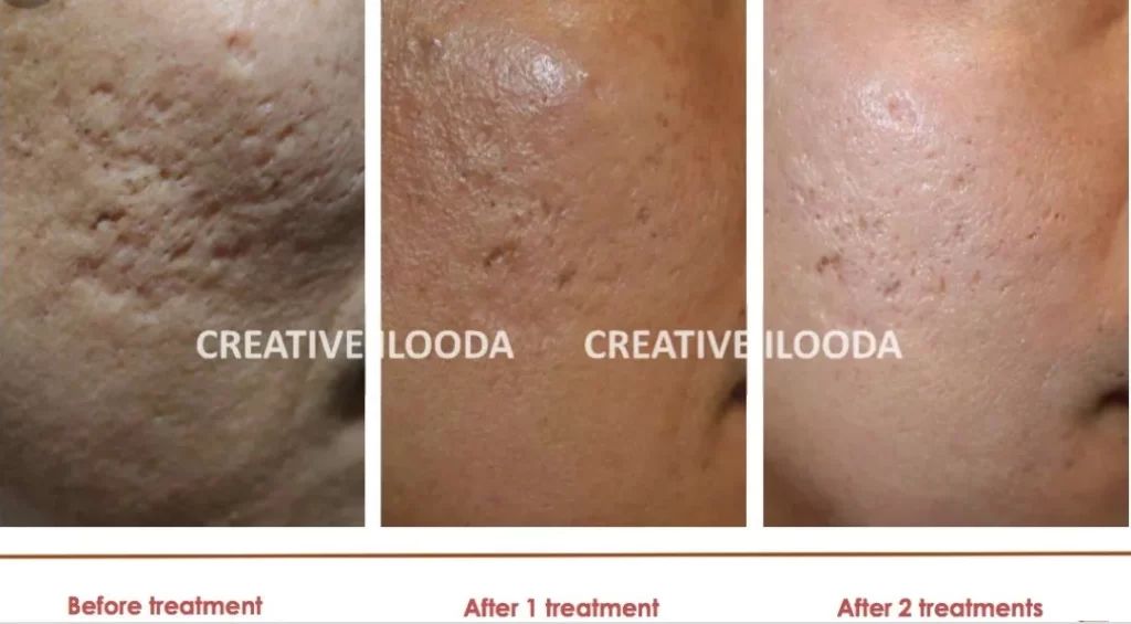 Secret RF™ | Buffalo, NY | DiMarco Body Sculpting & Aesthetics, LLC