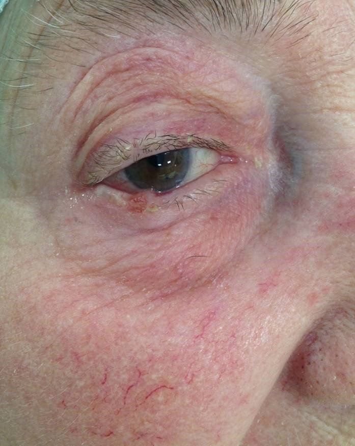 Carcinoma a cellule basali | Firenze | Santoro Dott. Nicola