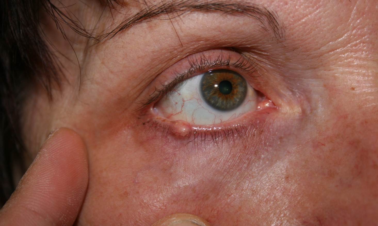 Infiammazioni oculari | Firenze | Santoro Dott. Nicola