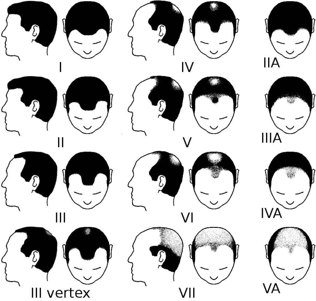 Harley Street Hair Transplant London | Beard & Eyebrow