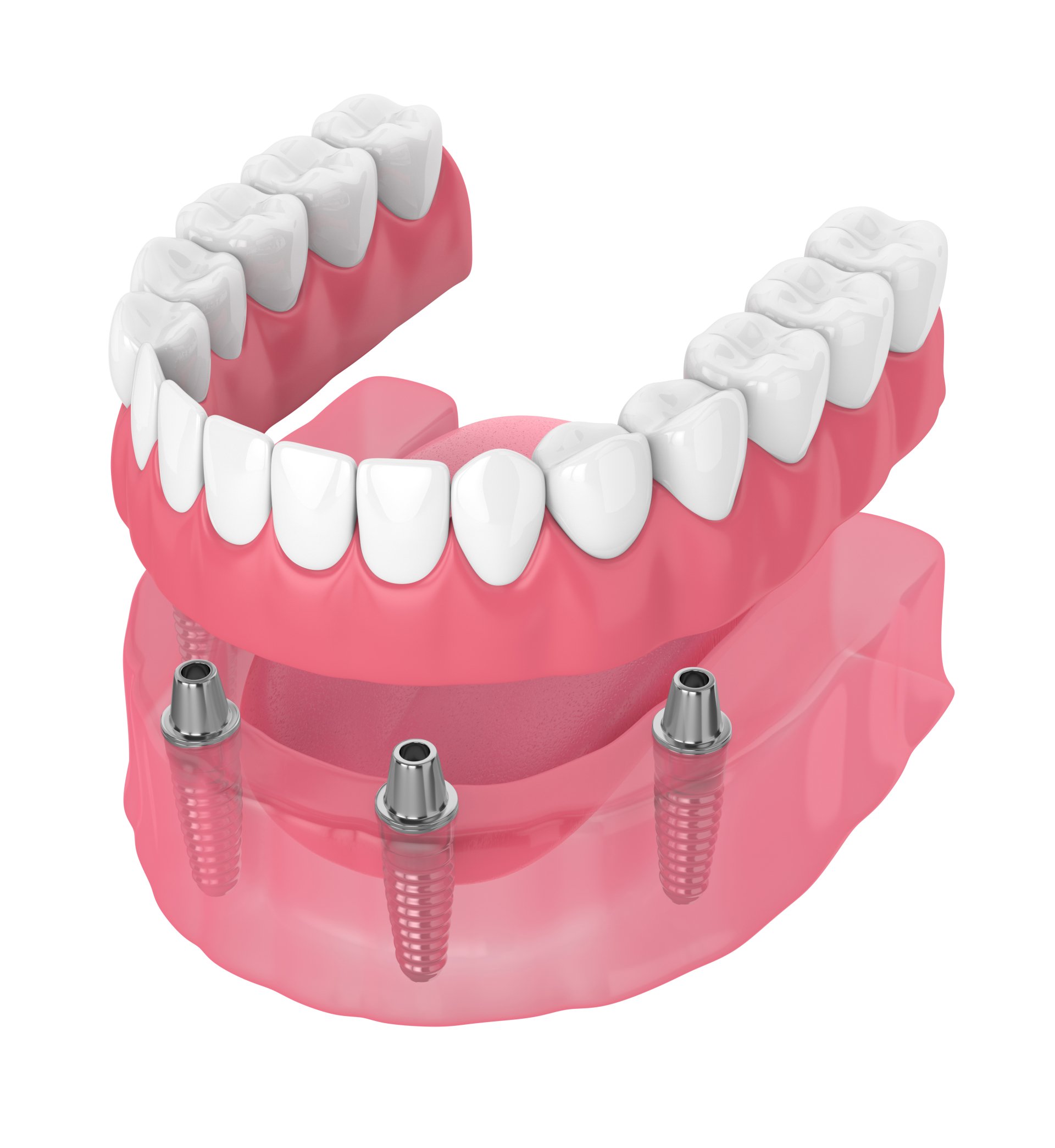 Snap On Dentures in Spring, TX | Overdenture Options