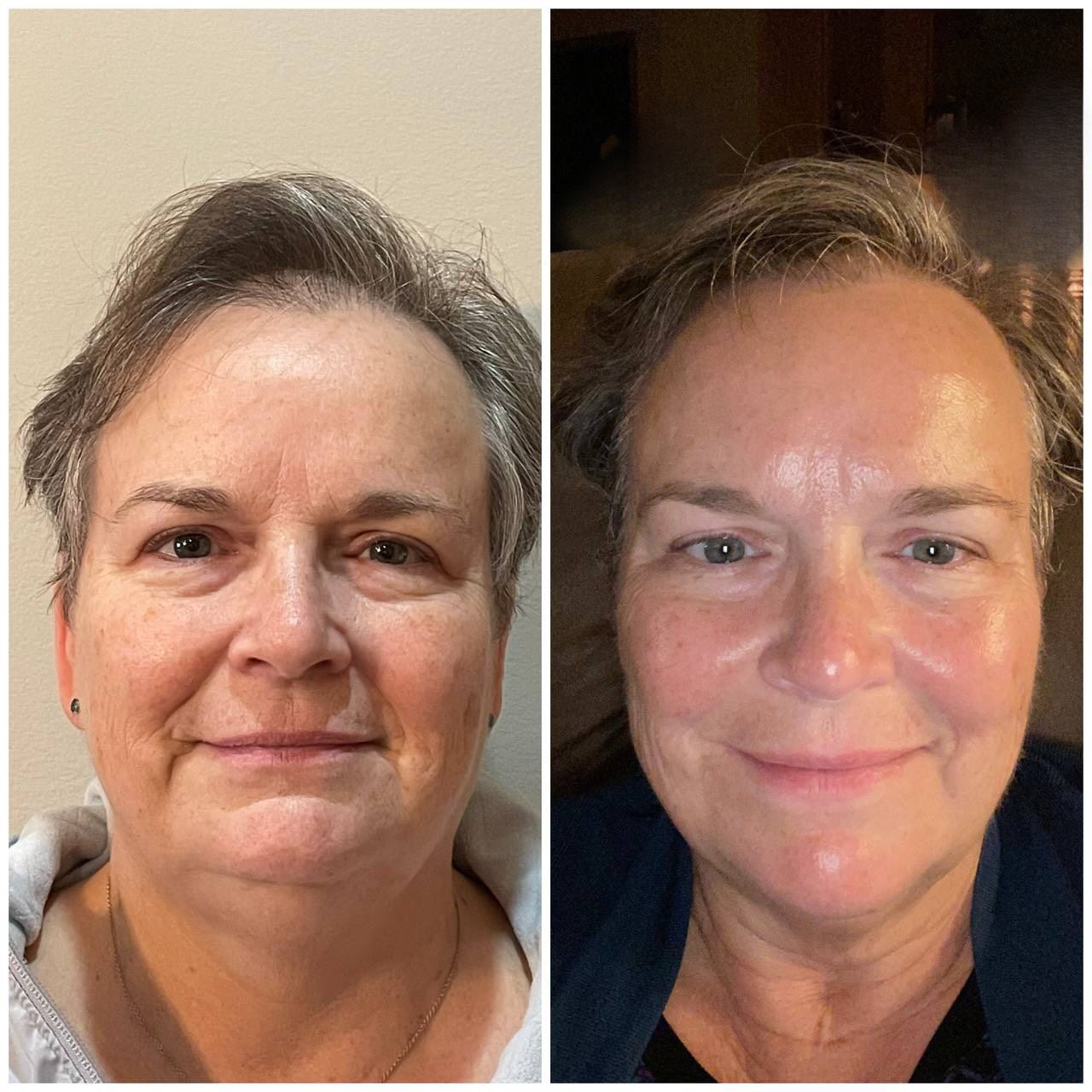 Cryoskin Services | Spring Park, MN | Skingevity Med Spa