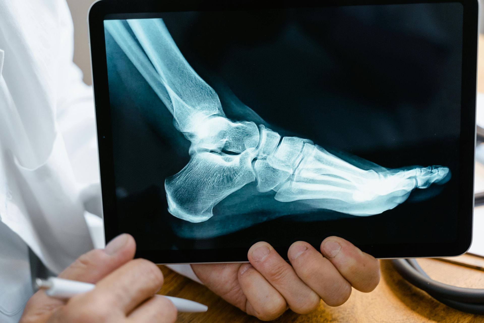 Understanding Bone Stress Injuries: Prevention, Symptoms...
