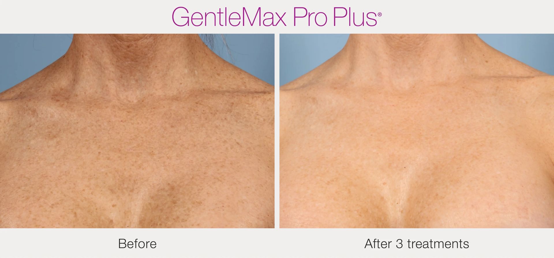 Laser Pigment & Rosacea Treatment