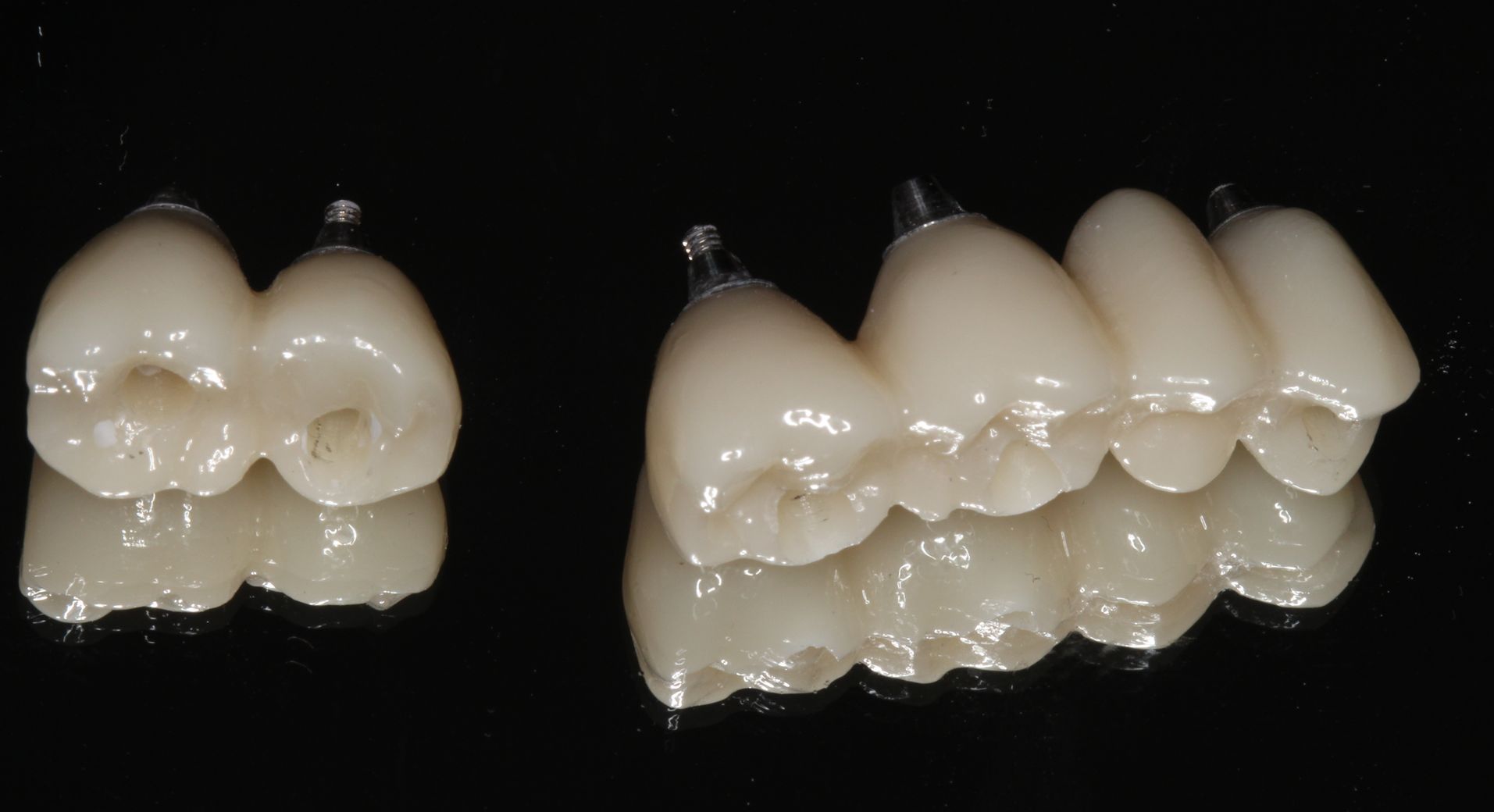 Implant-Supported Bridges | Corpus Christi 78404