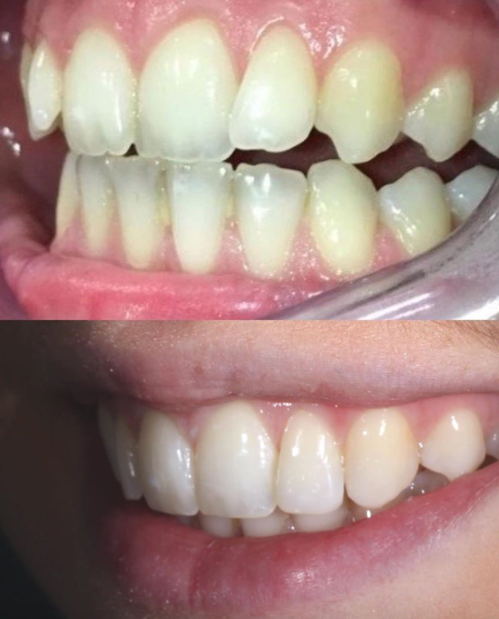 Direct Composite Bonding