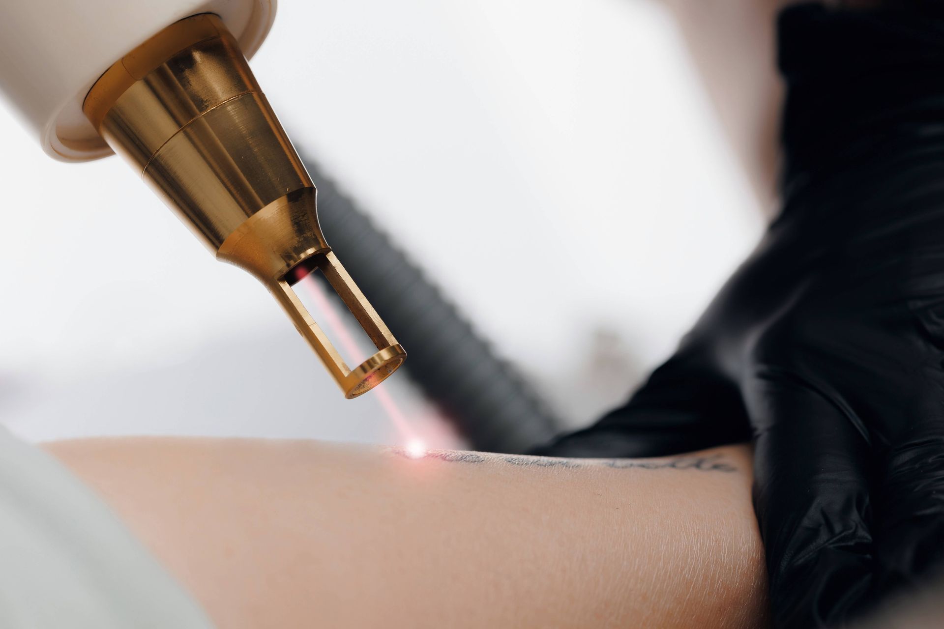 Lasers Changing Tattoo Removal | Lexington Tattoo Removal